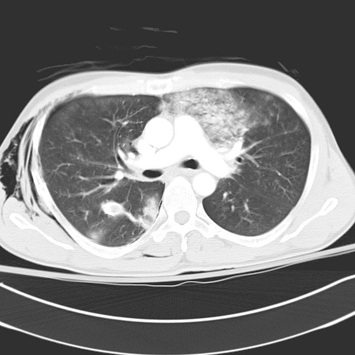 Pulmonary Contusions and Lacerations - by Alexander Baxter