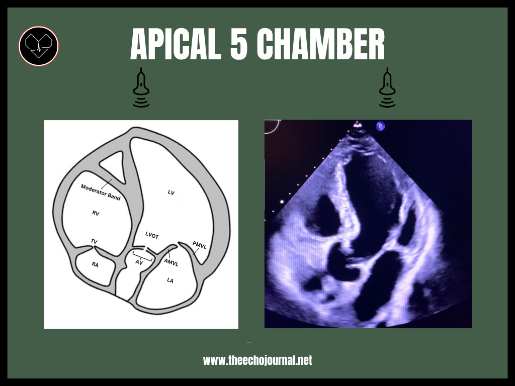 Apical 4 and 5: Technique, Landmarks, and Optimization