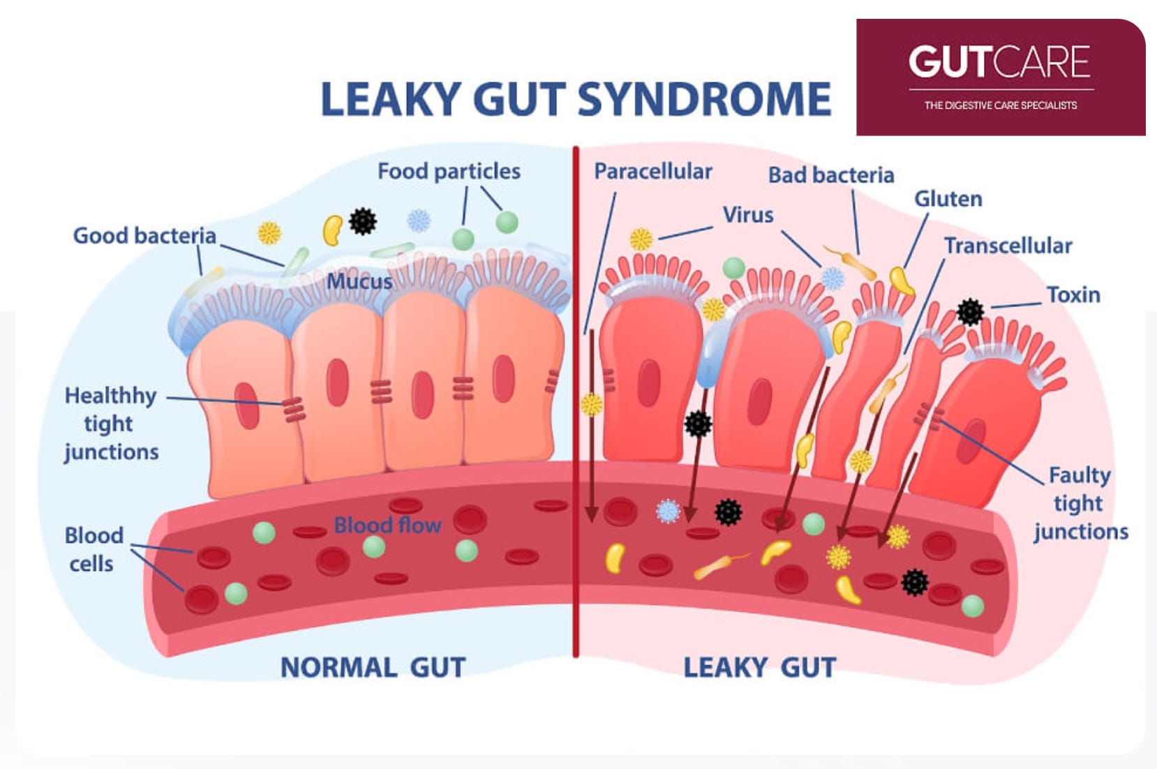 Leaky Gut: Supporting Your Gut Barrier From The Inside Out
