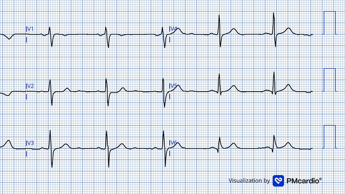 Inferior OMI ECG: Hyperacute T-Waves, Delayed Recognition, and ...