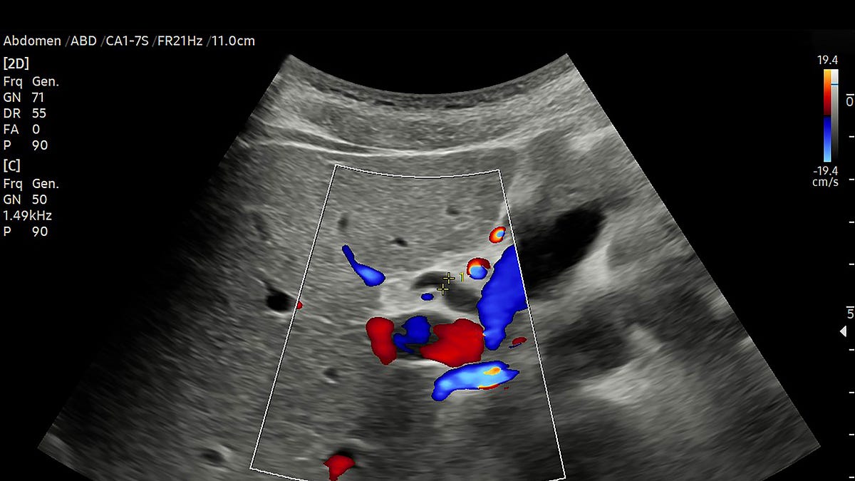 Inspiratory collapse of the inferior vena cava: What is it telling us?
