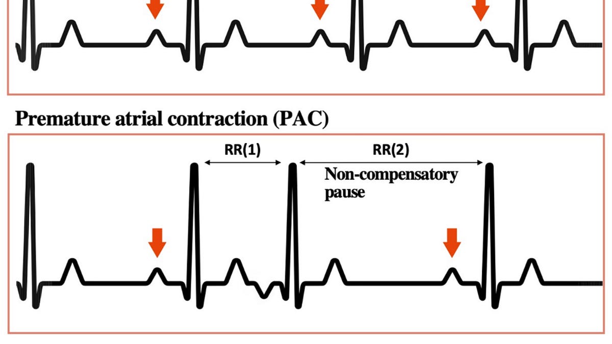Premature complexes: atrial vs junctional vs ventricular