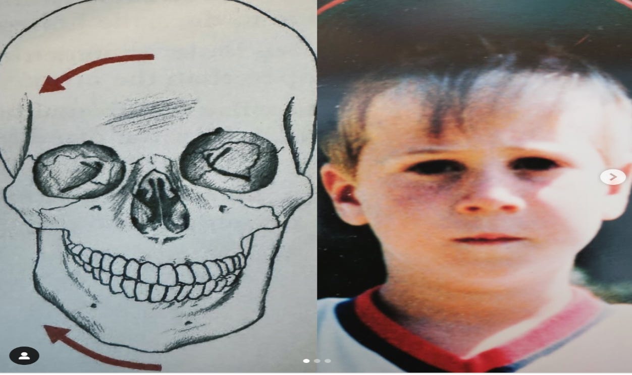 Does Reviv fix cranial strain patterns? - by EGK - Reviv