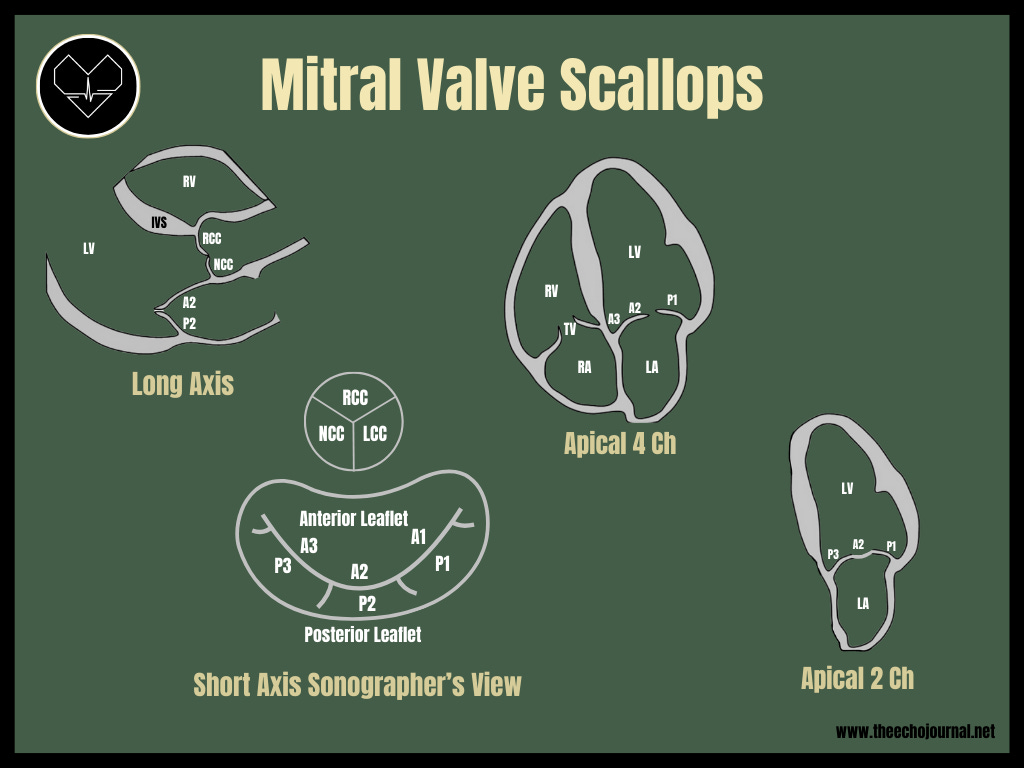 Mitral Valve Scallops: A Sonographer's View - by Aram K.