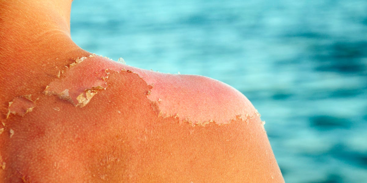 Sunscreen-gate - Particle WA