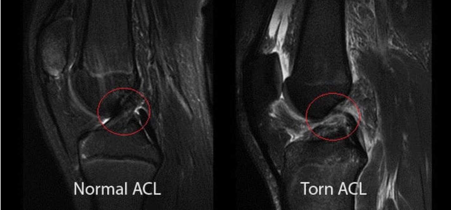 The ACL, Explained: How One Small Ligament Keeps Your Knee From Coming ...