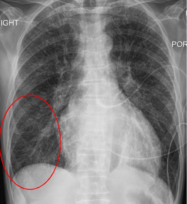 Como avaliar congestão pulmonar?