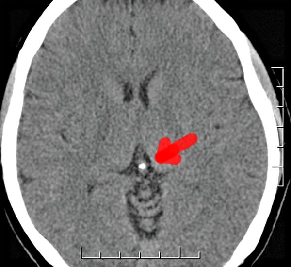 The Stone in Your Brain: How Modern Life Is Calcifying Your Pineal ...
