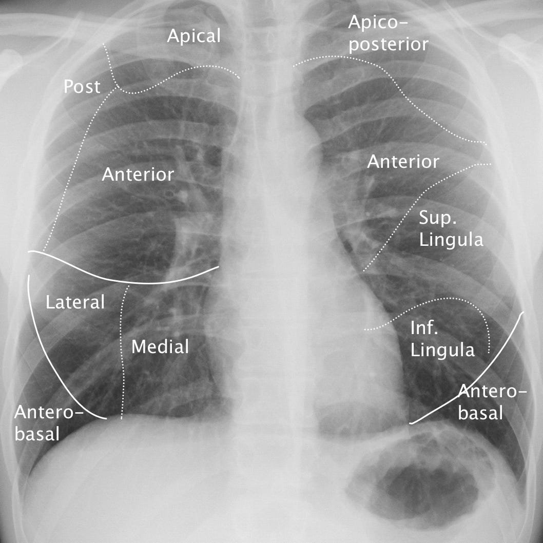 Chest anatomy - radiographs and CT - by Alexander Baxter