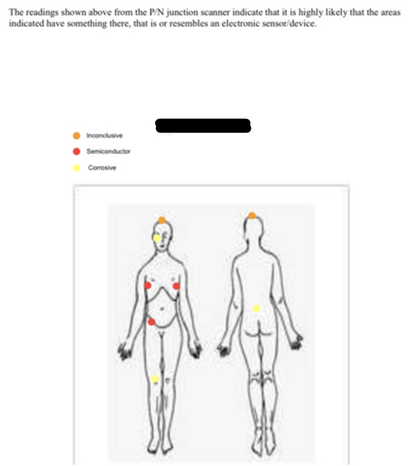 Targeted Individual With Proven Microchip Implants After Medical ...