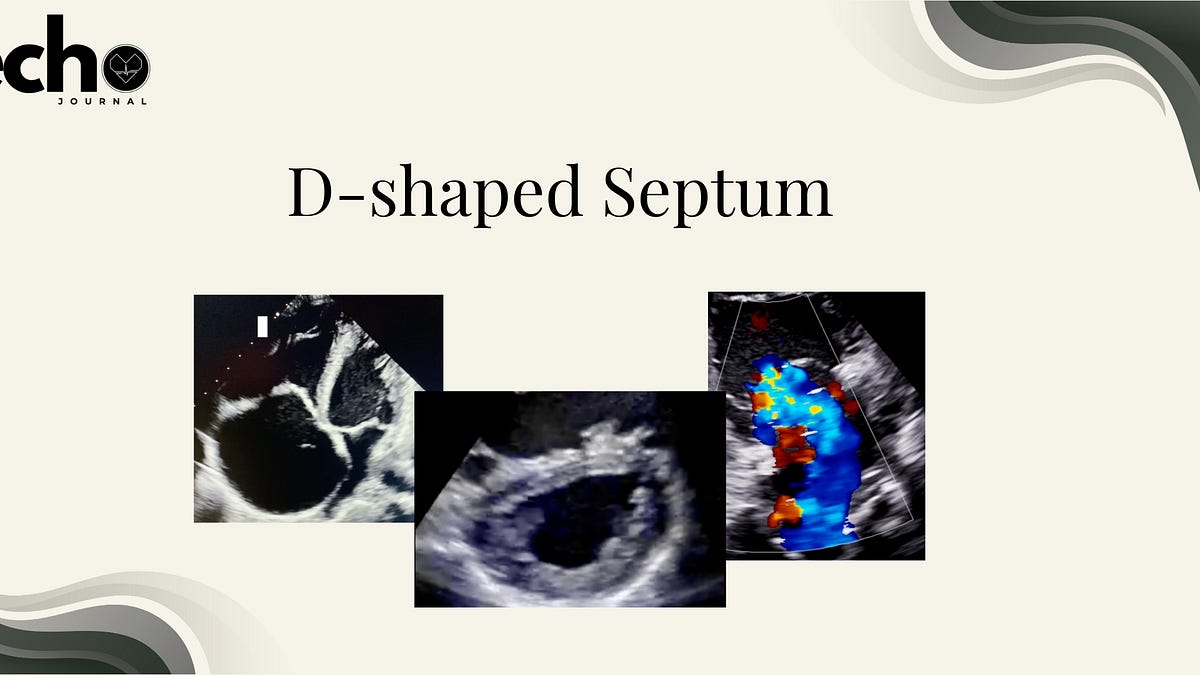 D-Shaped Septum: What Does it Mean? - by Aram K.