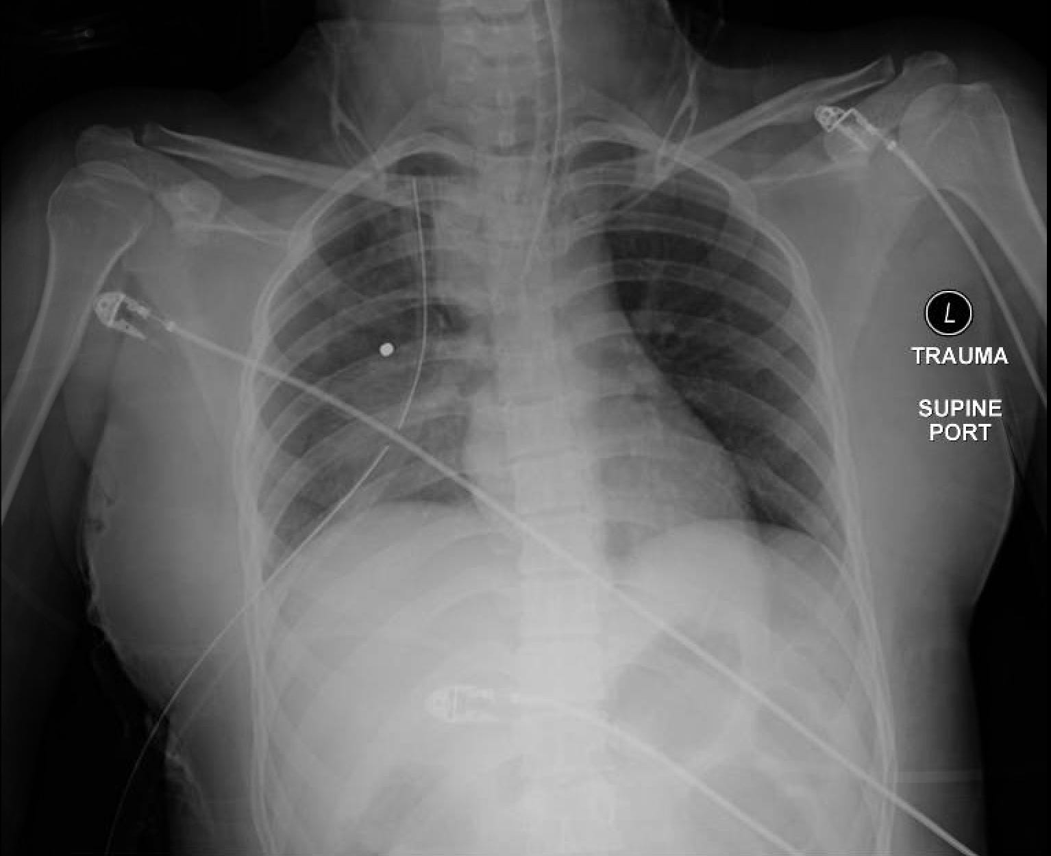Chest Tubes & Pigtails: 5 Must-Know Tips for ICU Rotation