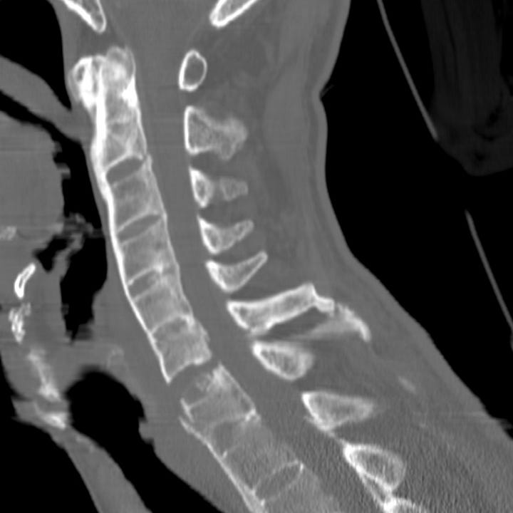 Spinal distraction injuries and dislocation