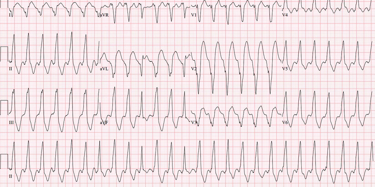VTach or something else? - ECG Teaching Cases