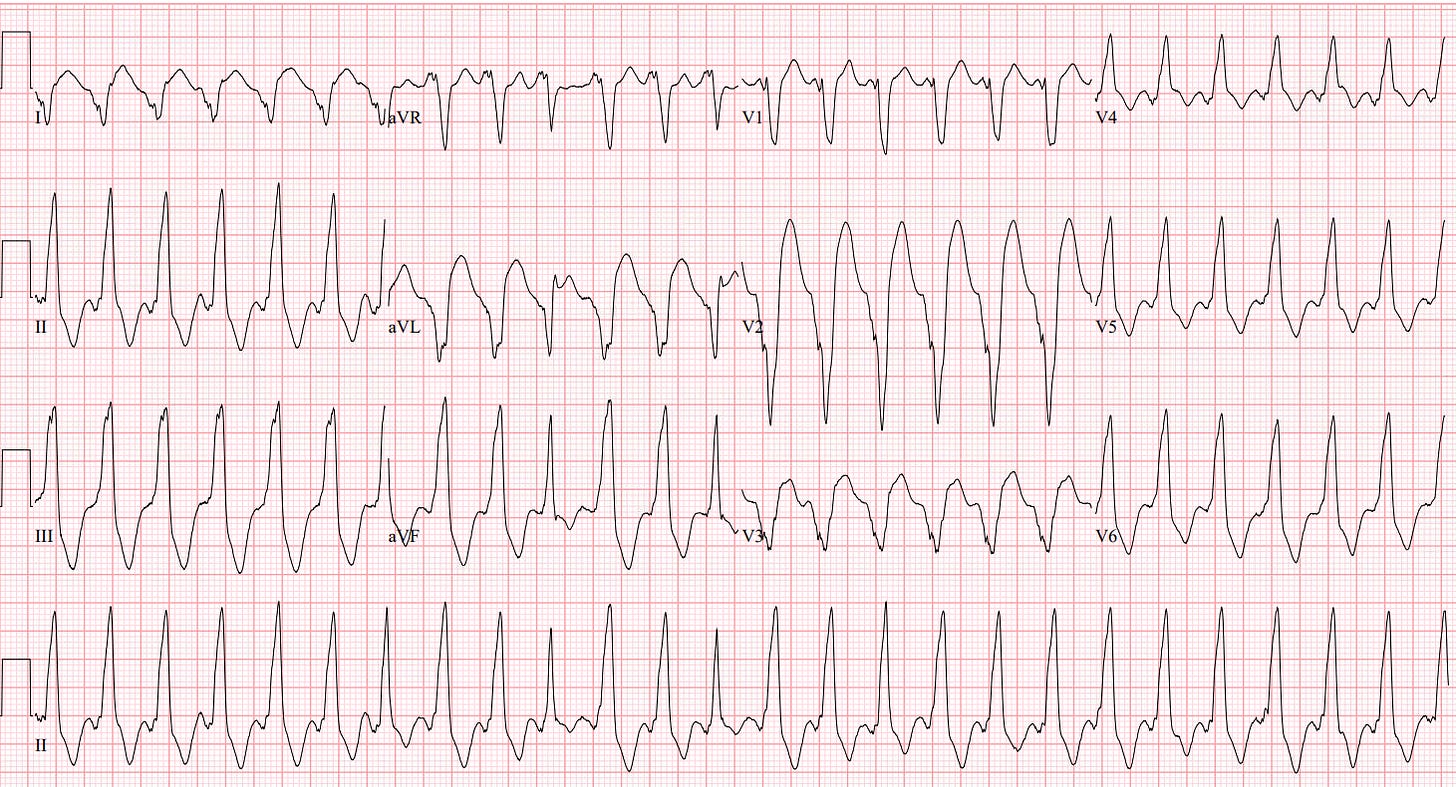 VTach or something else? - ECG Teaching Cases