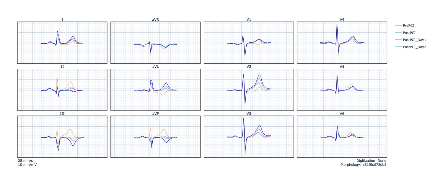 Inferior OMI ECG: Hyperacute T-Waves, Delayed Recognition, and ...