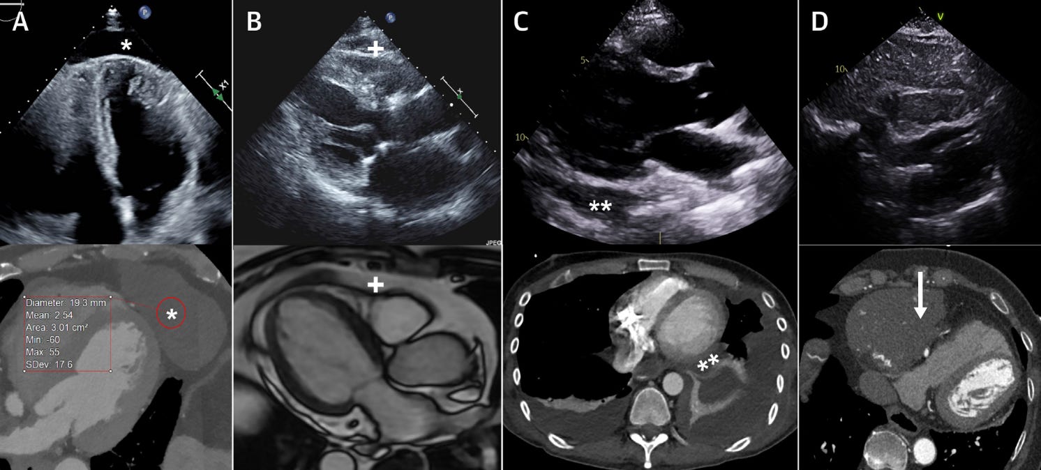 Manejo do Derrame Pericárdico