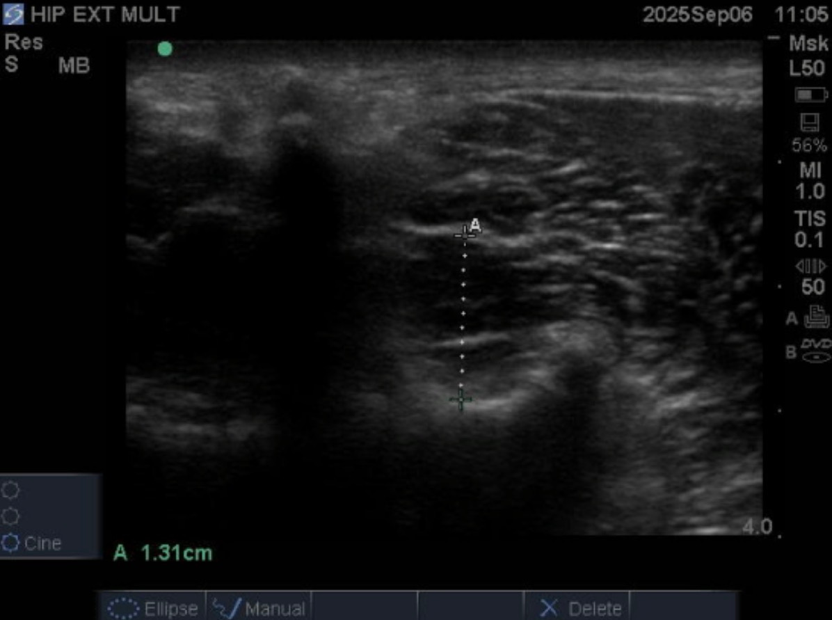 Inside the Isometric Contraction: Fascicle Shortening, Tendon Strain ...