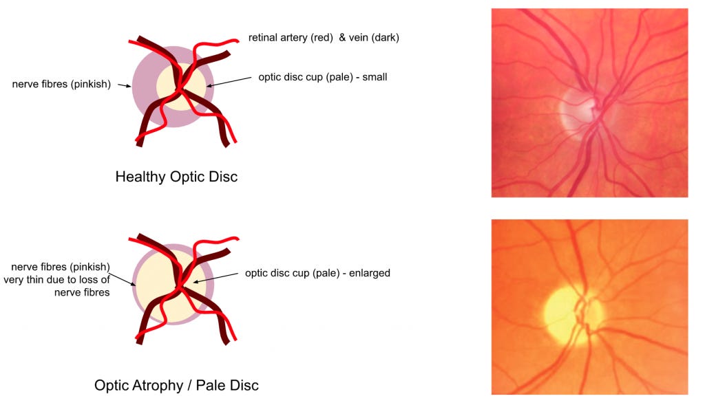 optic disc pallor