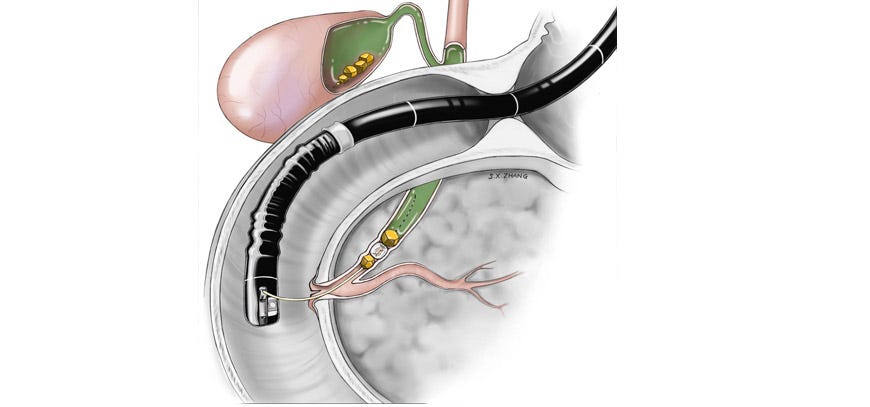 Endoscopic Retrograde Cholangiopancreatography Market Size and Growth ...