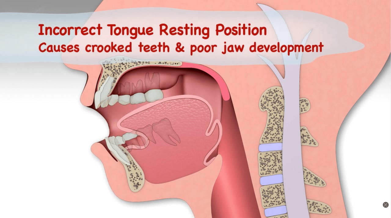 Mastering Proper Tongue Posture: A Guide for Improved Breathing and Posture