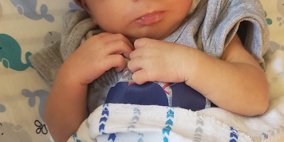 small head or microcephaly