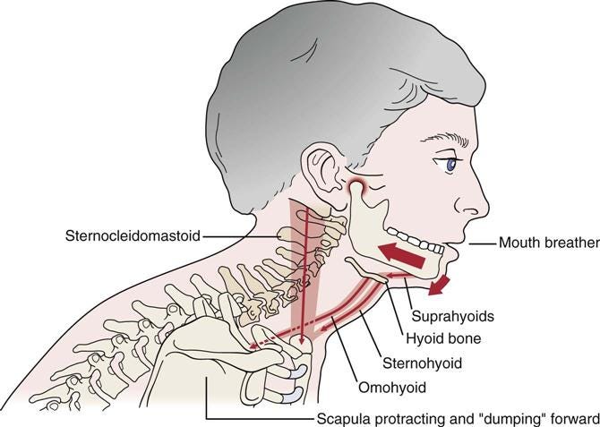 The Jaw-Spine Connection: Why Your Scoliosis Might Start in Your Mouth