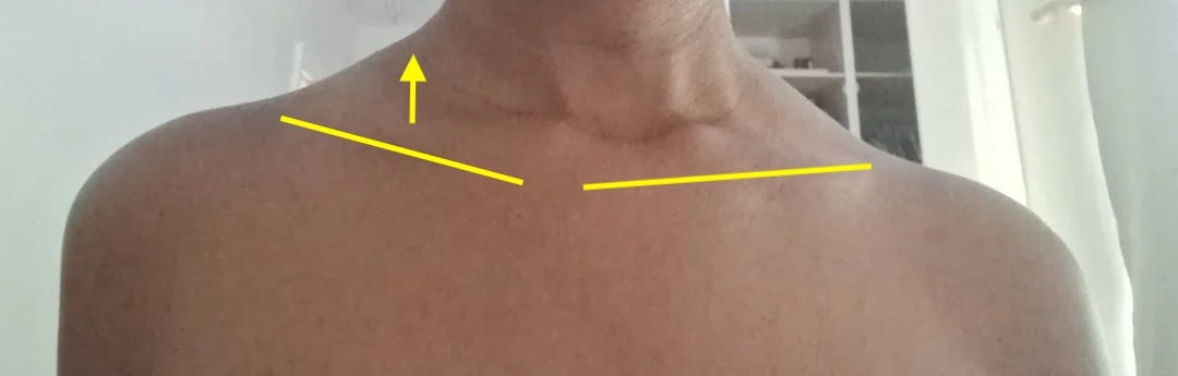 How To Fix Uneven Shoulders - Posturepro