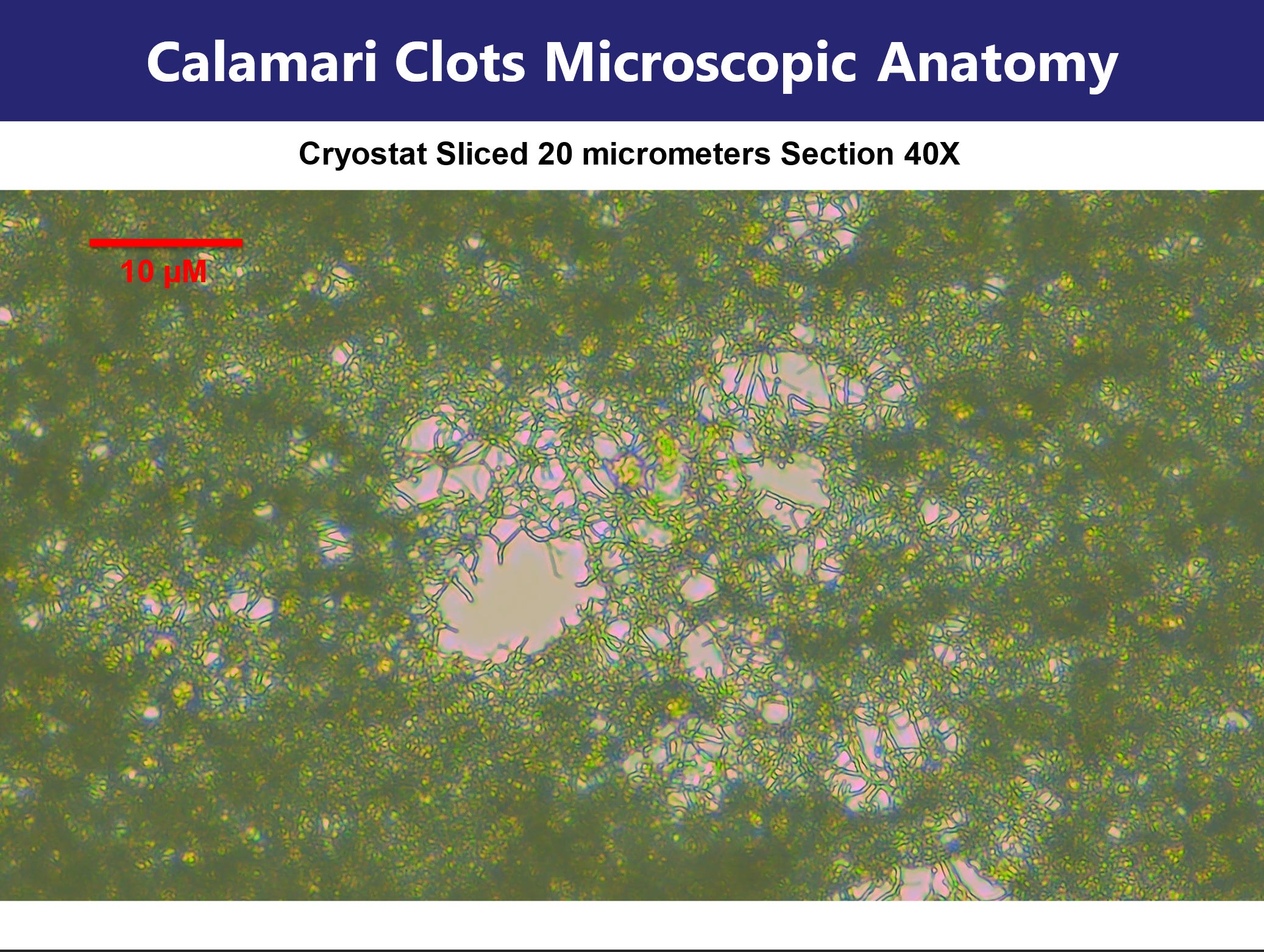 graviolateam finland: Anomalous Amyloid Microclots Found in 100% of the ...
