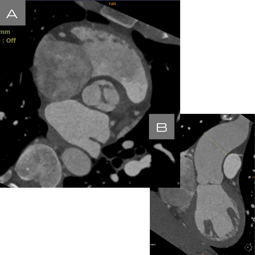 Types of Bicuspid Aortic Valve - by Aram K.