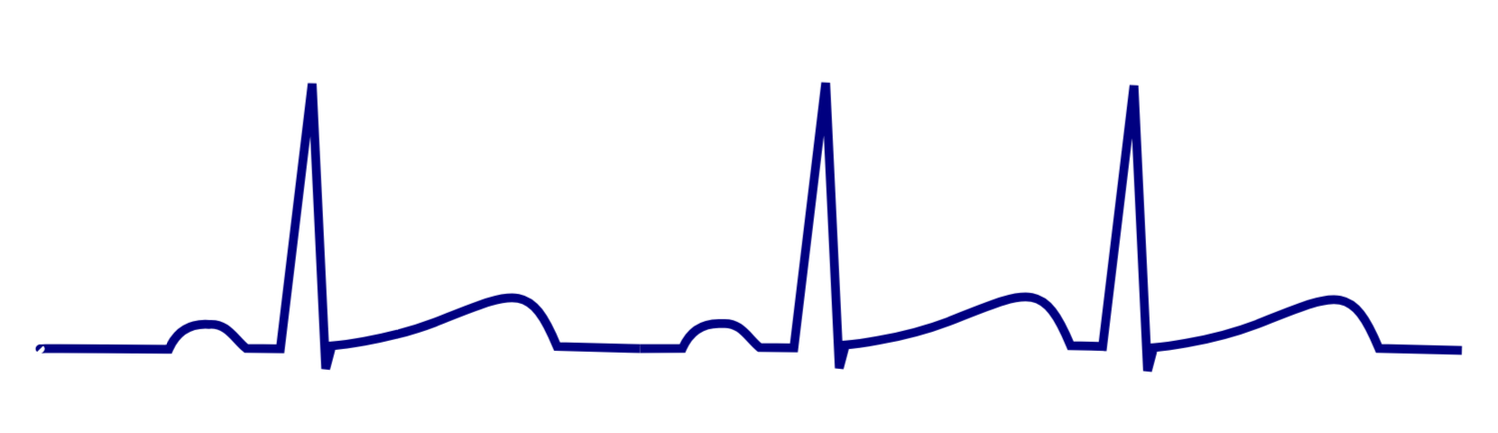 Premature complexes: atrial vs junctional vs ventricular