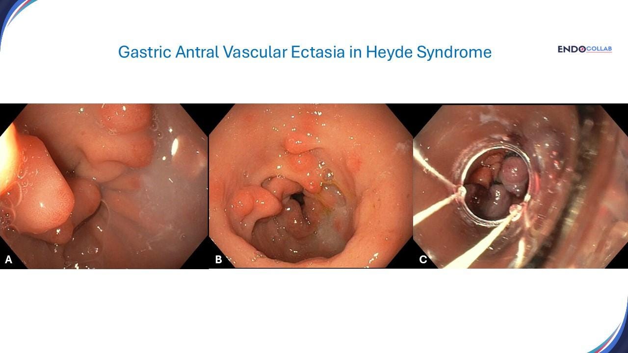 Gastric Antral Vascular Ectasia (GAVE) in Heyde Syndrome