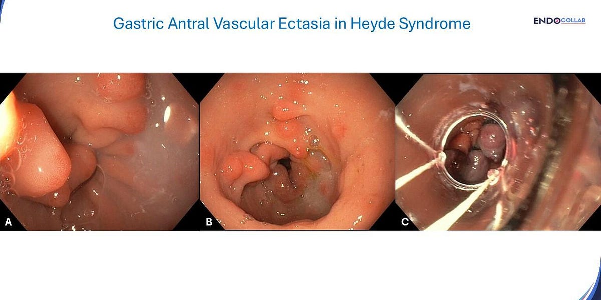 Gastric Antral Vascular Ectasia (GAVE) in Heyde Syndrome