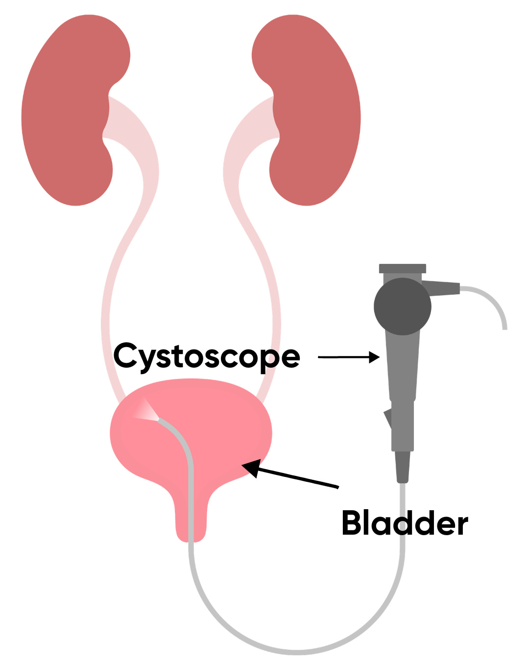 Is Cystoscopy Painful? A Urologist’s Guide to Safe Bladder Procedures ...