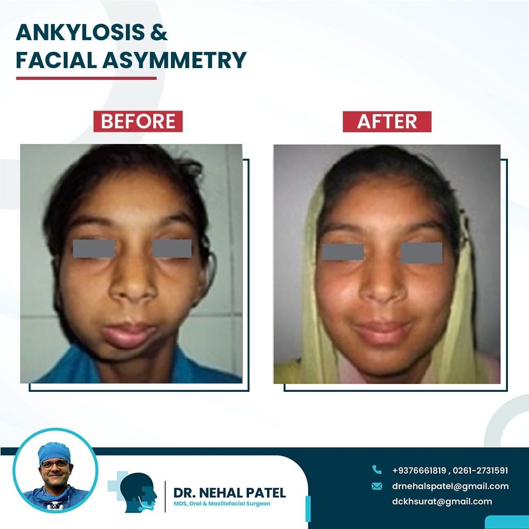 Is Your Jaw Stuck? Signs and Treatments for TMJ Ankylosis
