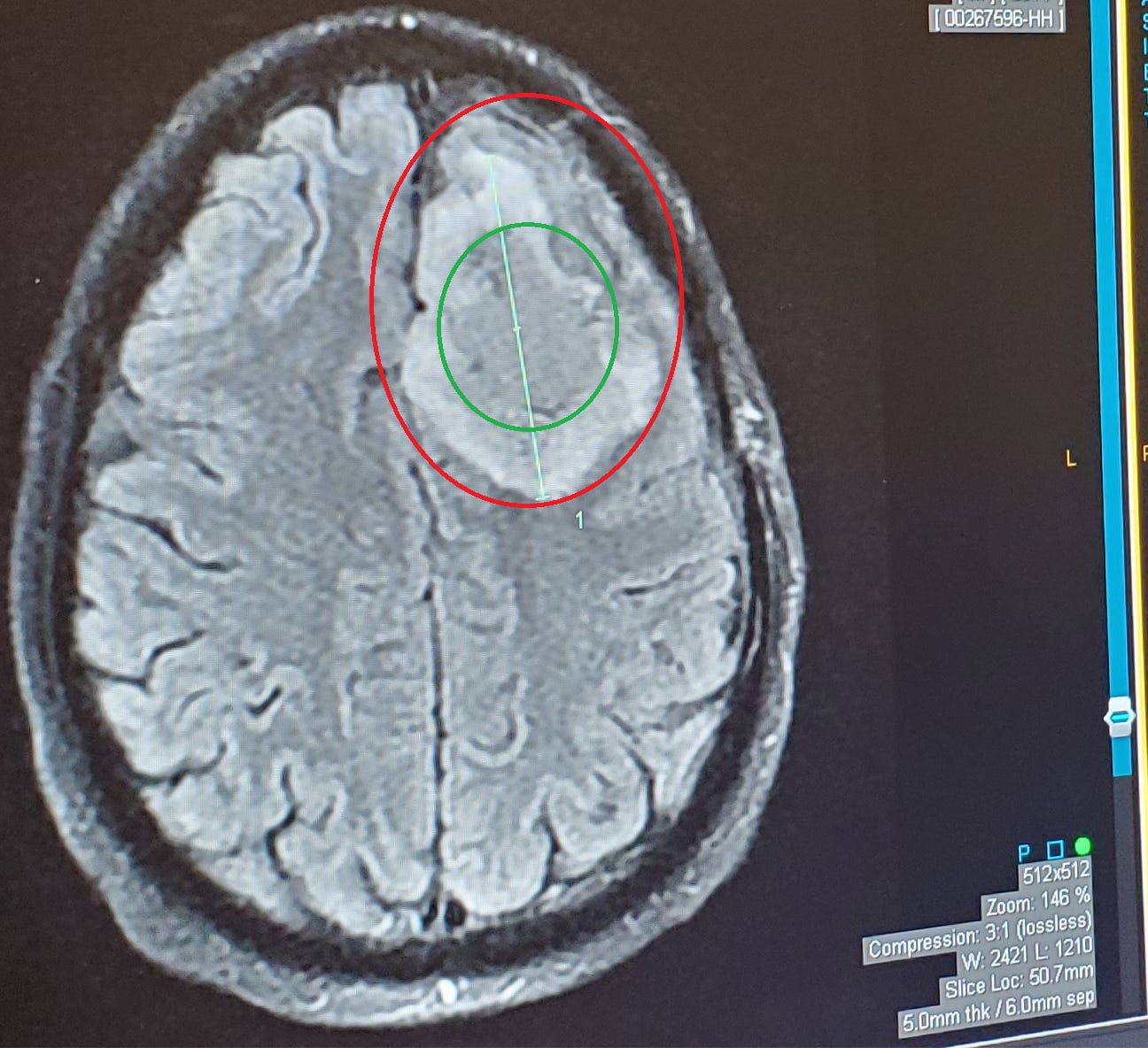 All MRI scans as of 05/17/2024: (Updated on 05/22/2024 with new pictures)