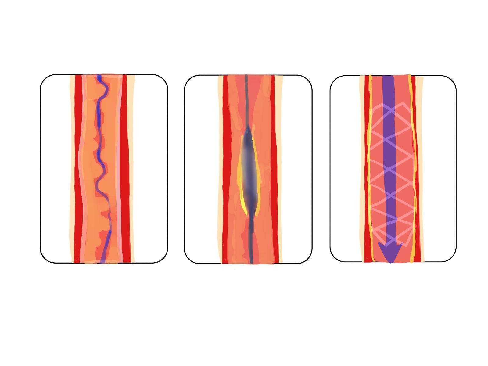 護理筆記系列 – 週邊血管疾病 - 薇布WeiBuh💉護理站