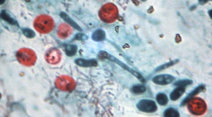 Cryptosporidium outbreak in Wales rises to 81