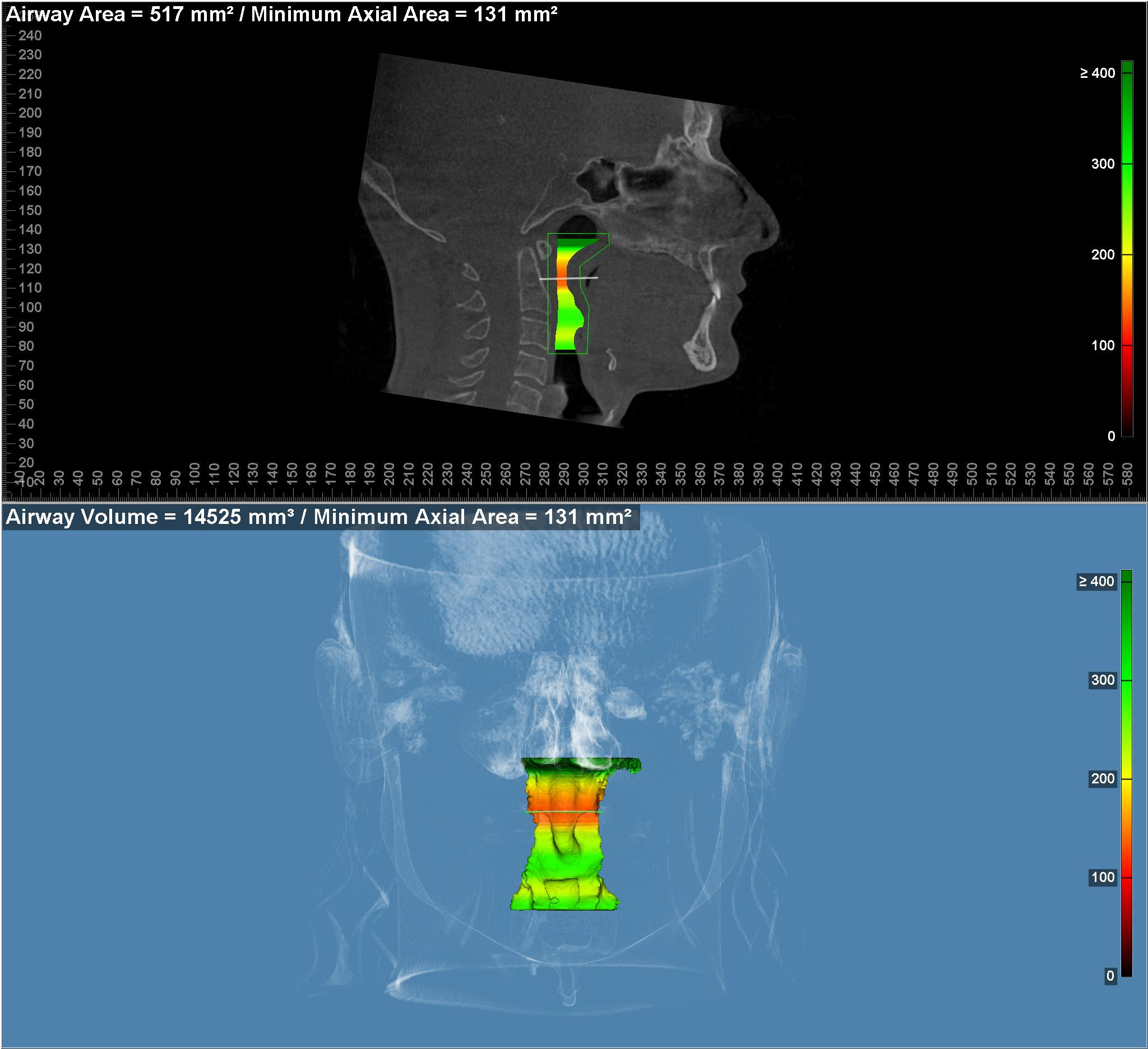 7.1 Keeping MARPE in Its Lane - by Ronald Ead - JawHacks