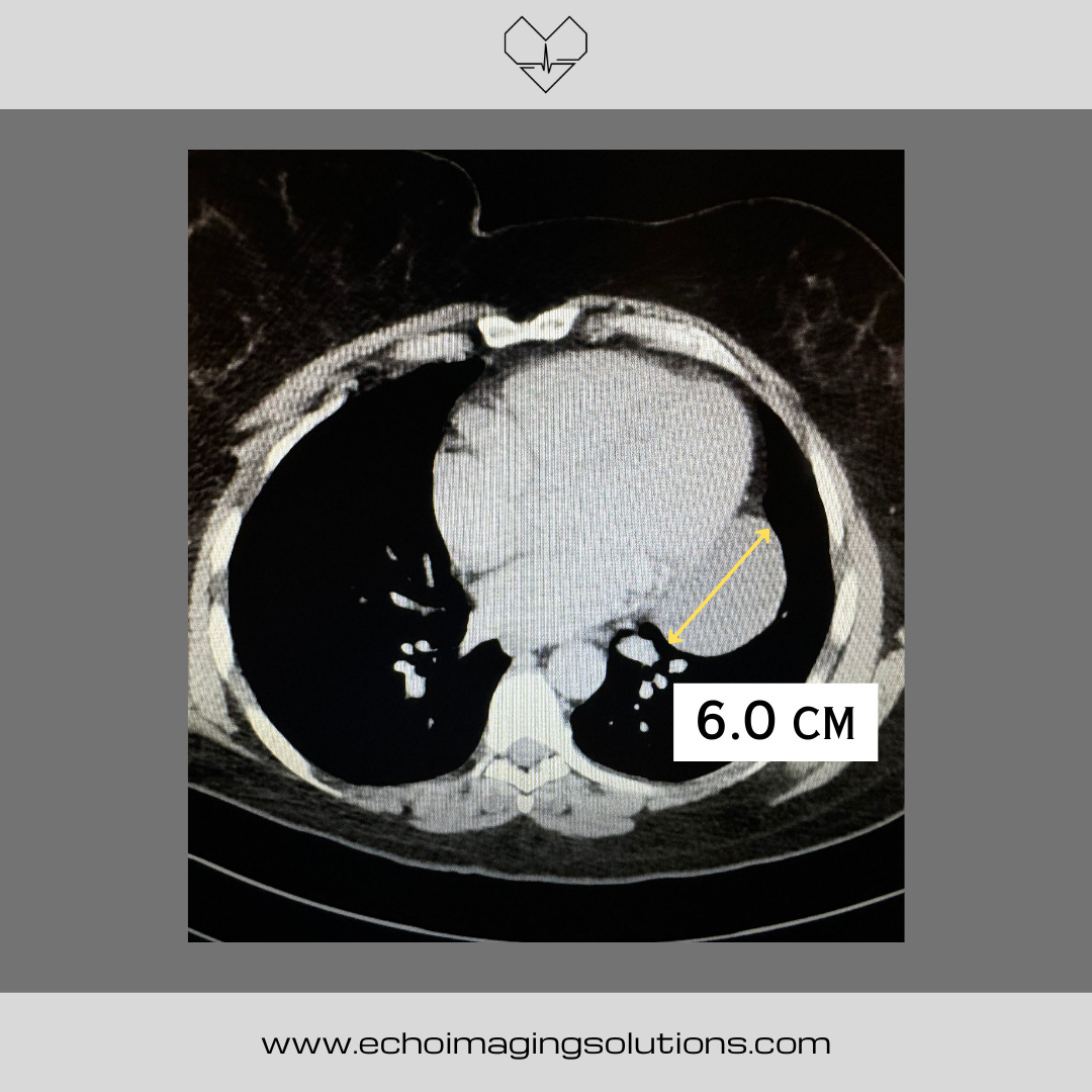 What Is A Pericardial Cyst? - The Echo Journal