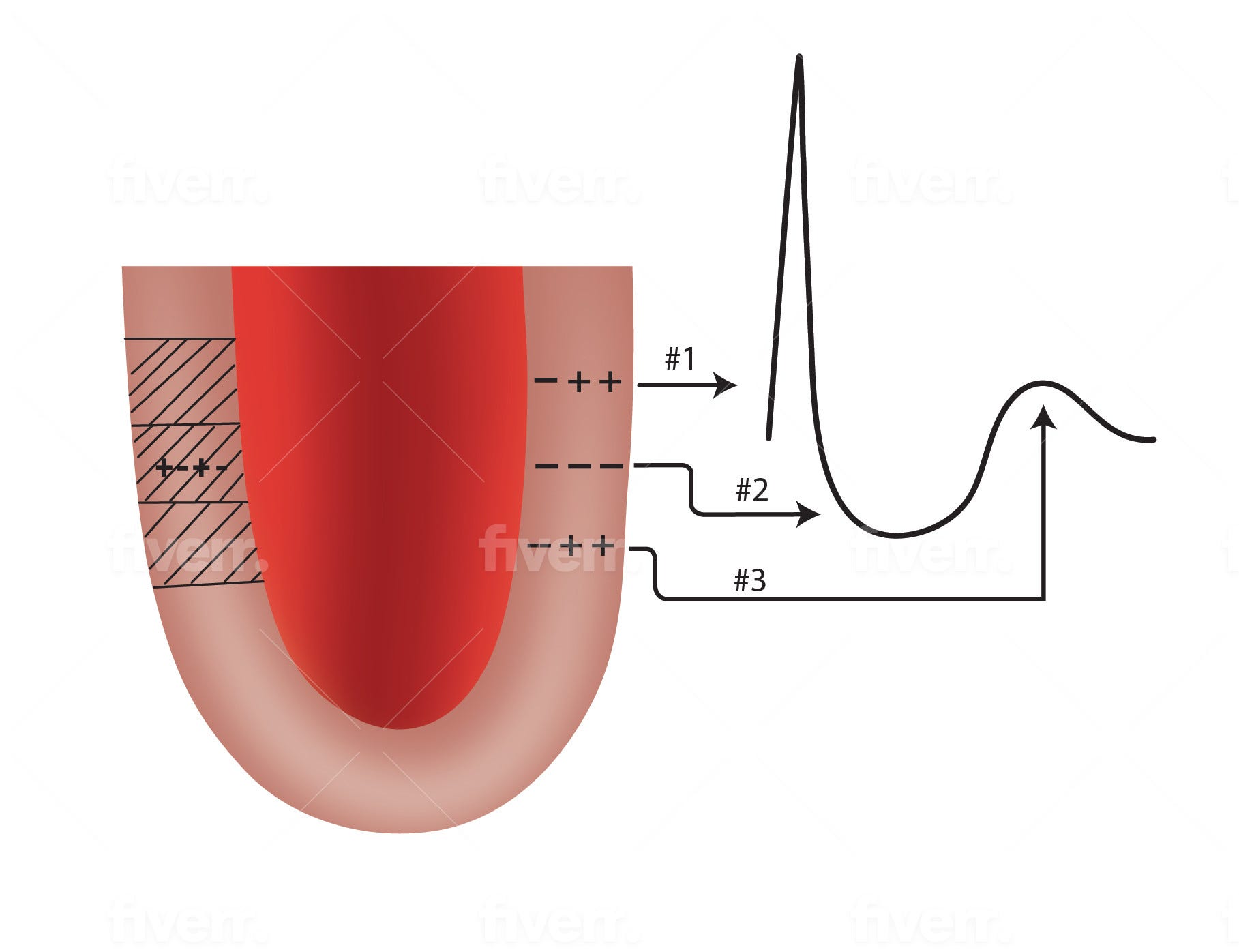 Don't Miss Posterior Wall MIs - by Paul D. Thompson, MD