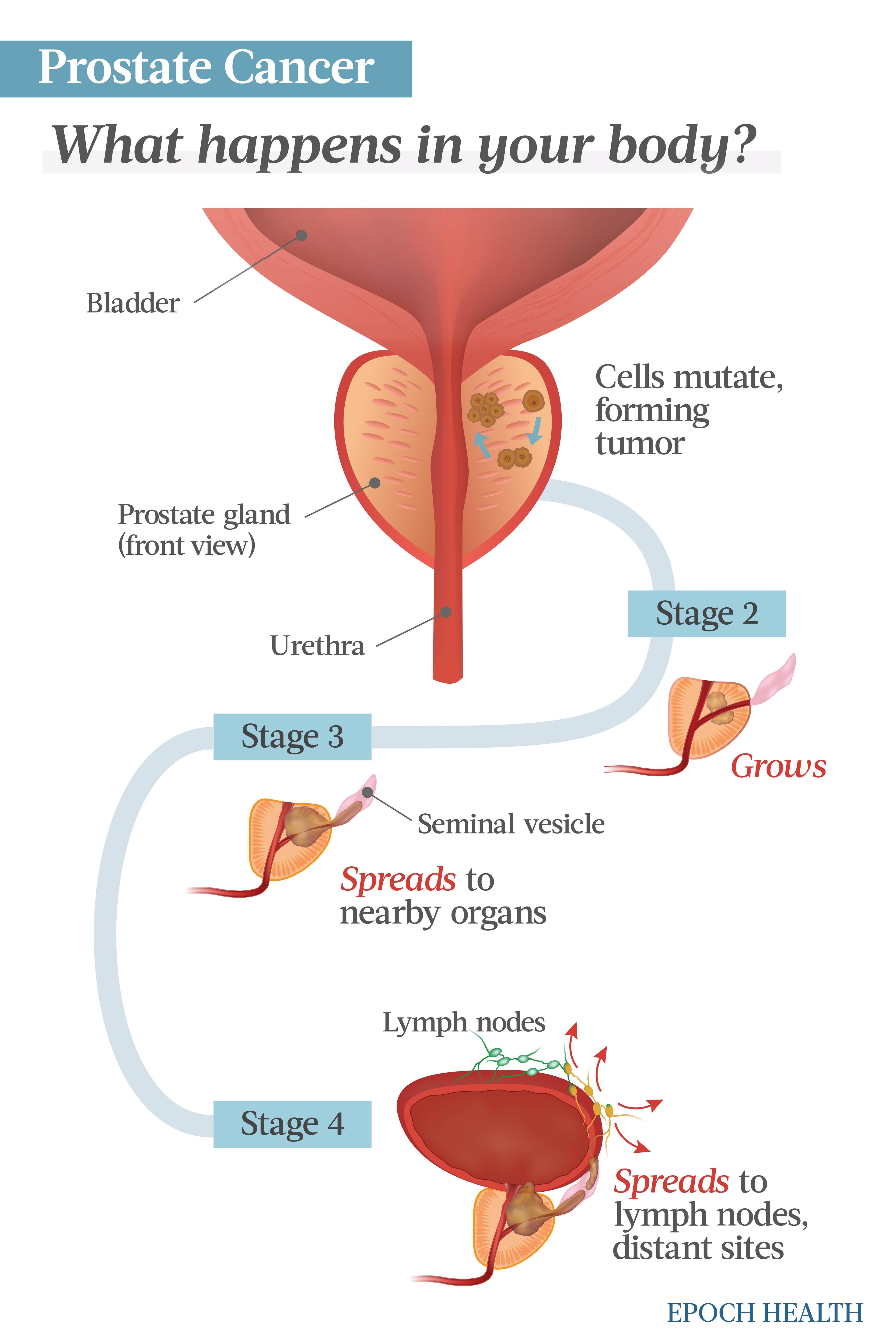 Prostate Cancer: Symptoms, Causes, Treatments, and Natural Approaches