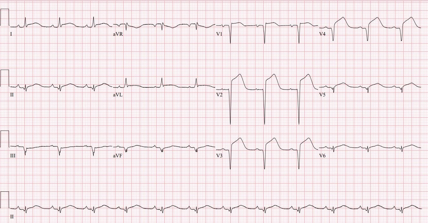 STEMI… I think? - ECG Teaching Cases