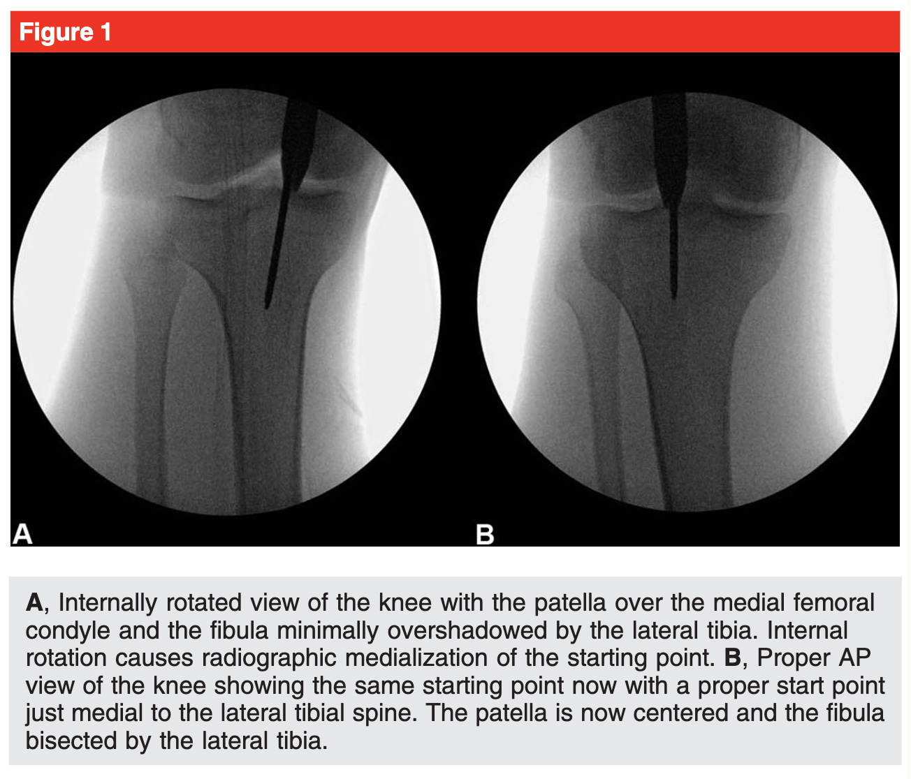 A Review Of Proximal Tibia Entry Points For Intramedullary, 52% OFF