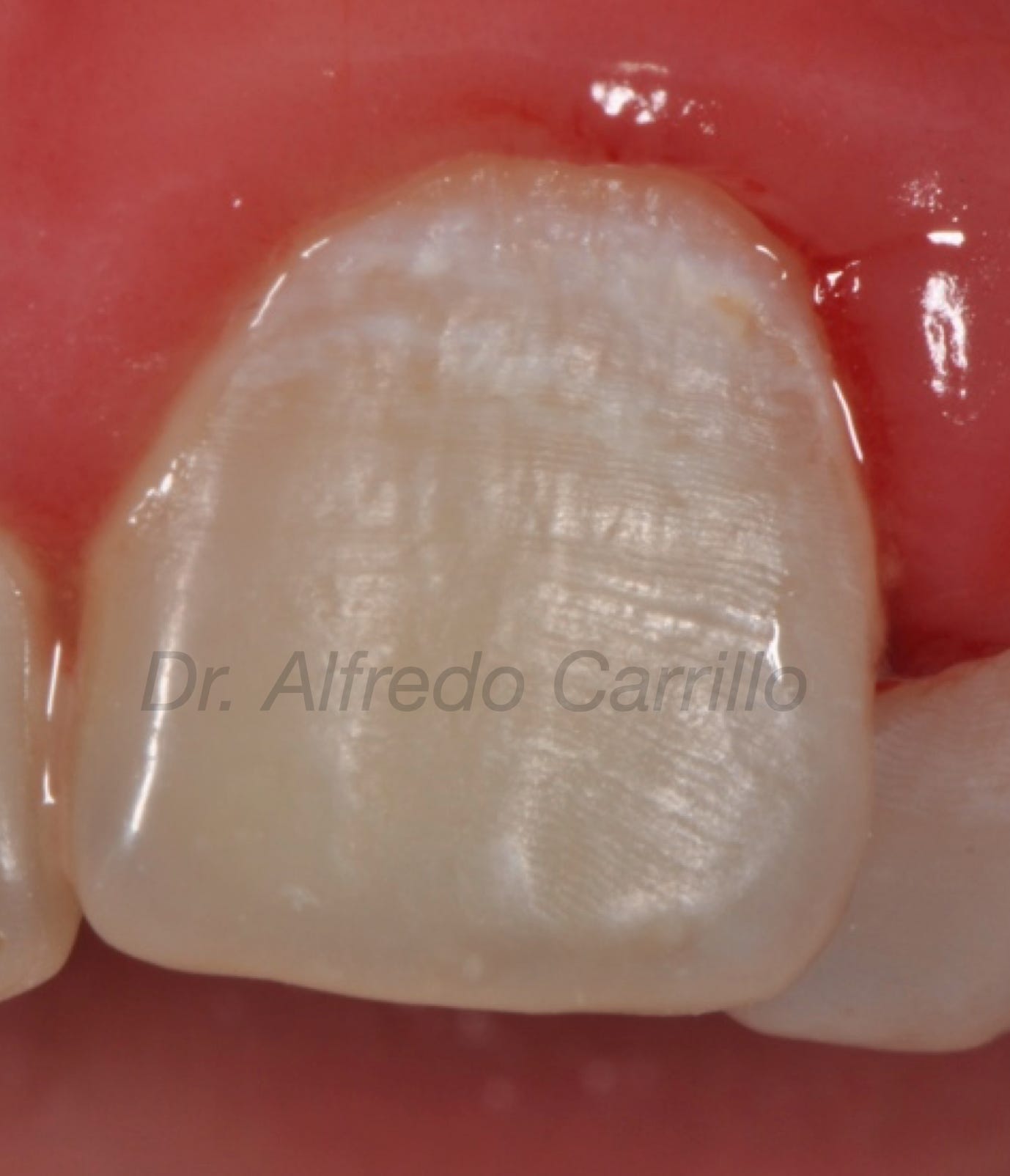 Comportamiento de una lesión cariosa - by Alfredo Carrillo