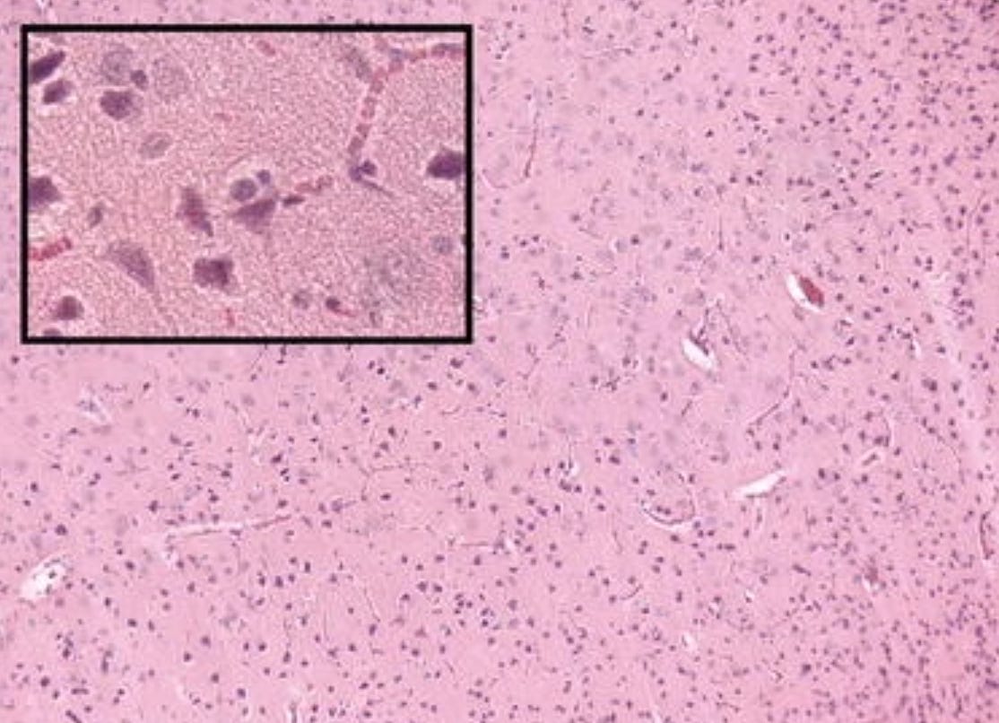 Removing the brain from the skull in brain banking: much more than you ...