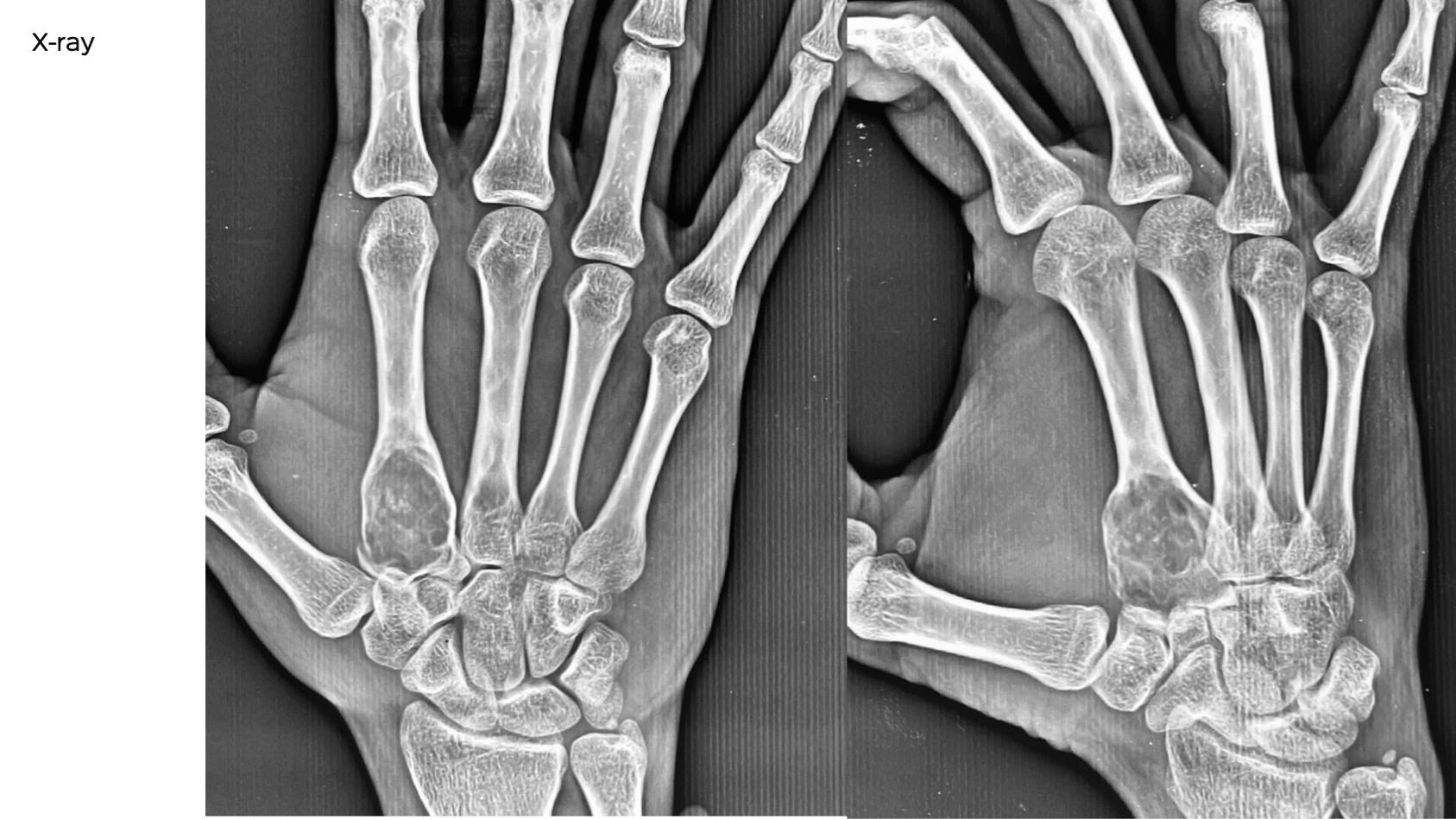 Case 26: A Dorsal Hand Swelling - by Bhavin Jankharia