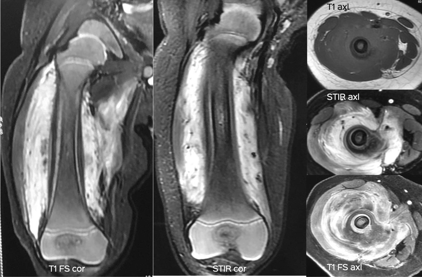 Case 20: A Scary Femur - by Bhavin Jankharia