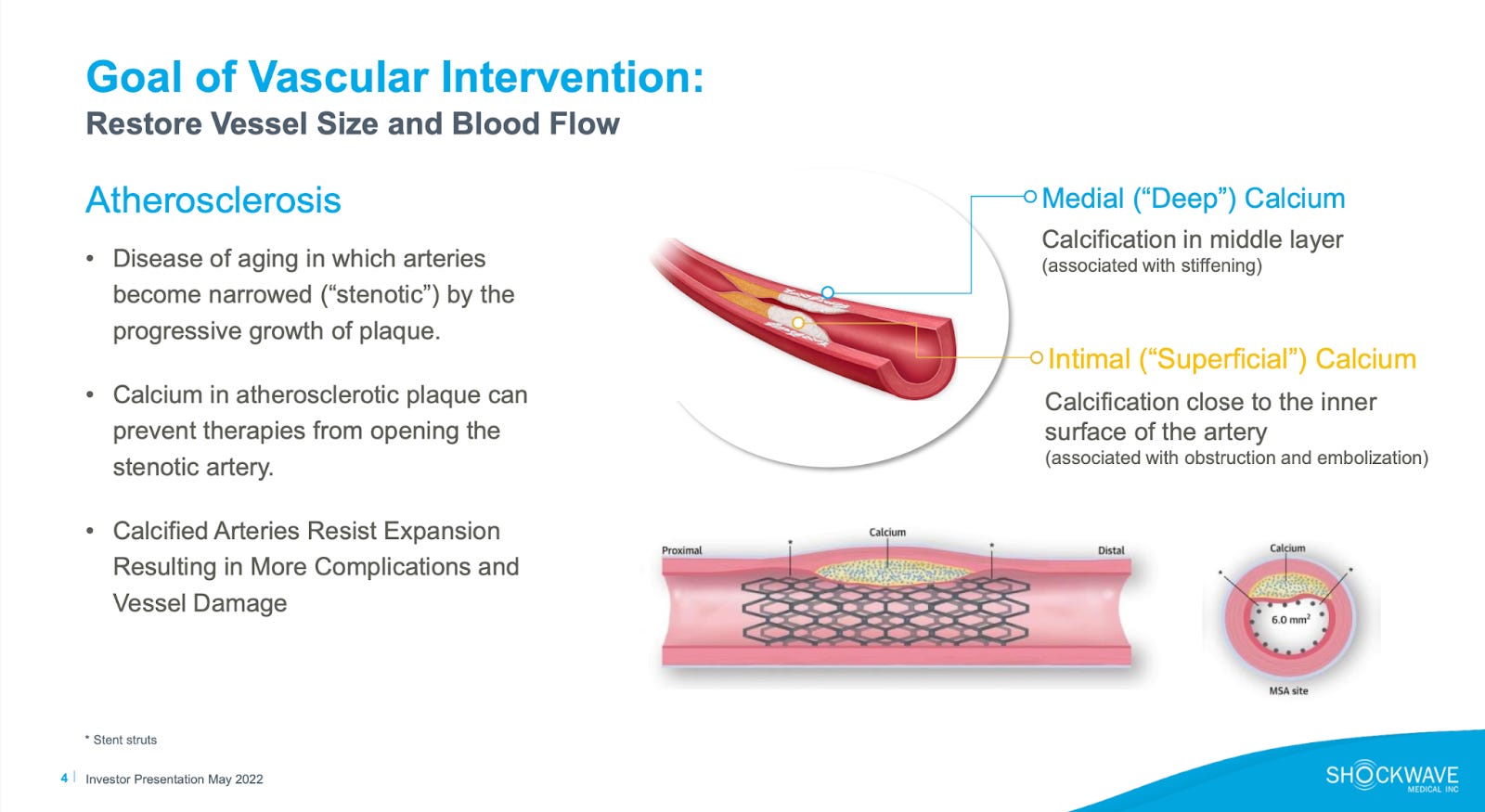 Deep dive on Shockwave Medical ($SWAV) - by Jonah Lupton