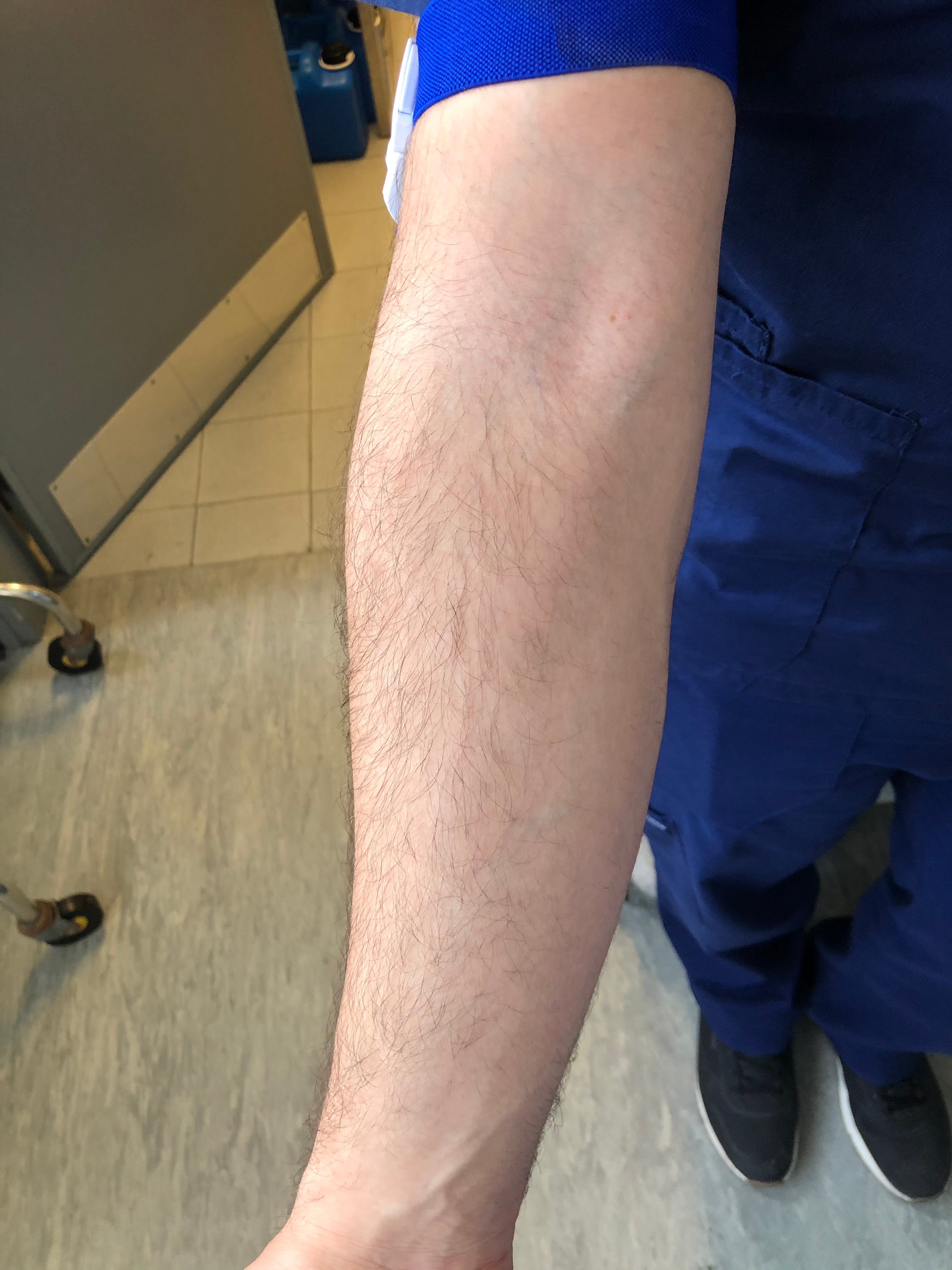 Alcohol = Solution to your phlebotomy and cannulation problems